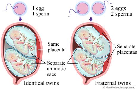 Twin Pregnancy Types Cigna