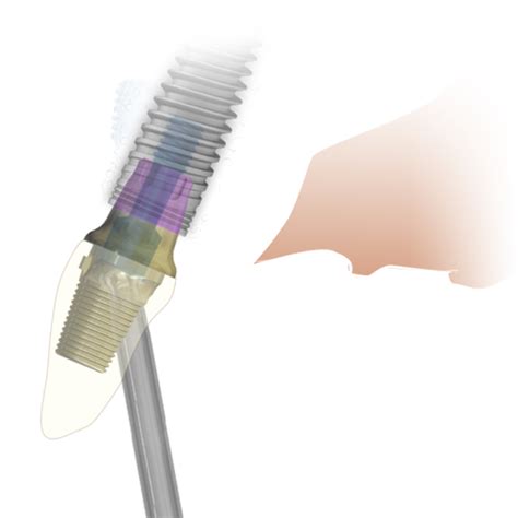 Mis Dental Implants Technology Mis Dental Implants