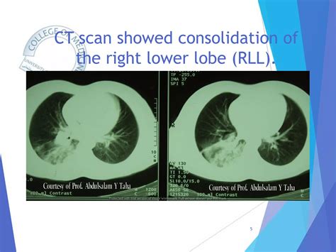 Suspected Right Lower Lobe Bronchiectasispdf