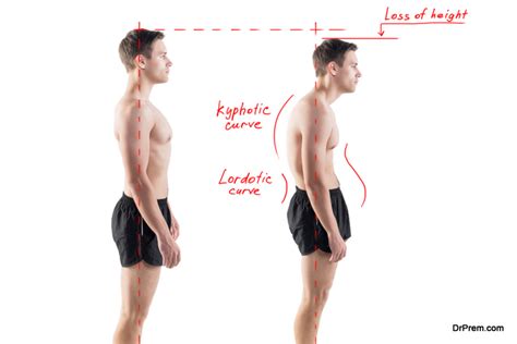 9 Common Postural Deviations And How To Correct Them