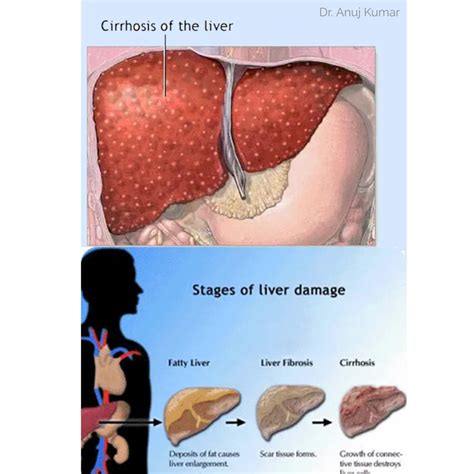 Parenchymal Liver Disease Liver Parenchymal Disorders Radiology Key