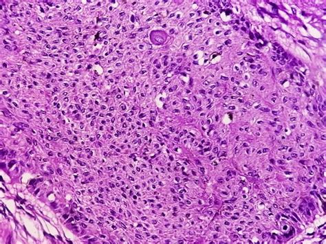 Images De Epidermoide Téléchargement Gratuit Sur Freepik