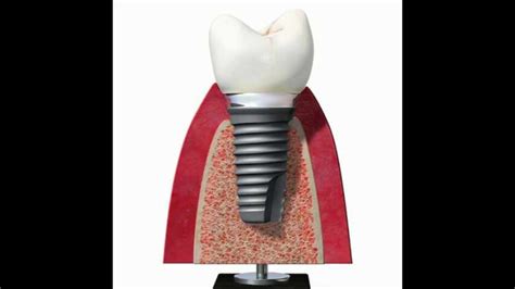 파주임플란트 발치 즉시 임플란트로 부담 줄이는 법 네이버 블로그