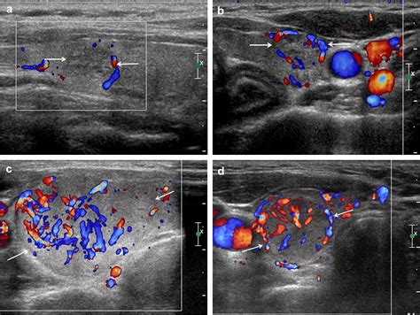 Solid And Isoechoic Thyroid Nodules Without Malignant Sonographic