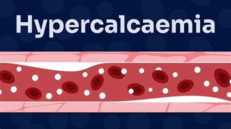 Hypercalcaemia An Oncological Emergency Ausmed Lectures