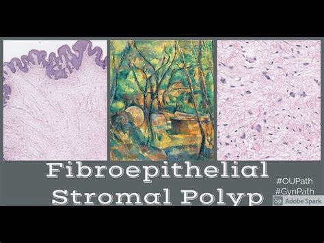 Fibroepithelial Polyp Histology