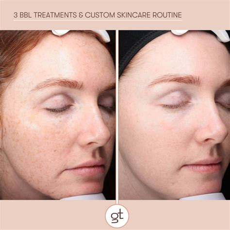 Before And After Gallery Of Bbl Hero Photorejuvenation Results