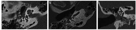 A C Ct Scan Of The Right Temporal Bone Axial Section A Showing Download Scientific Diagram