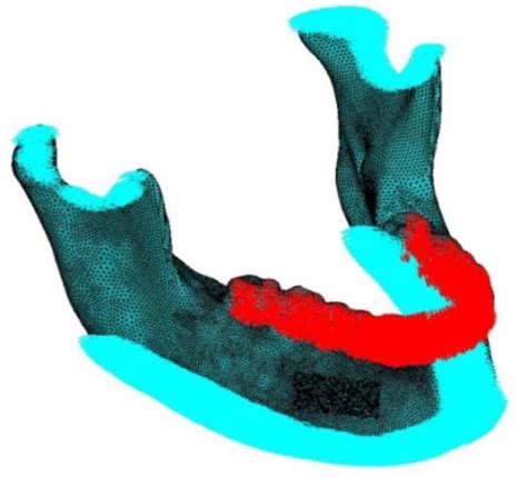 Finite Element Analysis Of A Scaffold Inserted Into A Mandible With Download Scientific Diagram