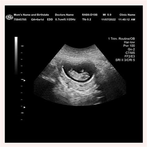 6 Week Ultrasound Ultrasounds