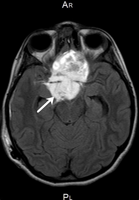 T1 Weighted Brain Mri Post Contrast Axial View Shows A Large Download Scientific Diagram