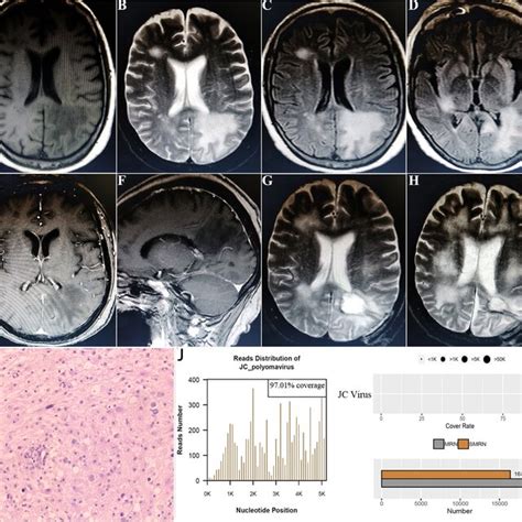 Mr Imaging Findings Histopathological Specimens And Gene Detection Of Download Scientific