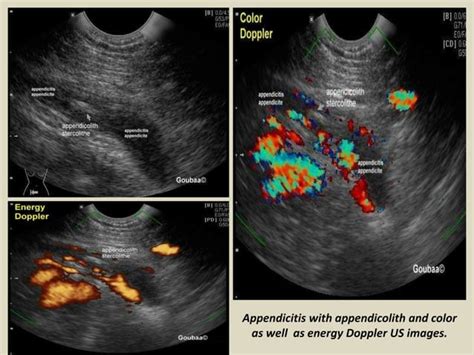 Presentation1 Pptx Ultrasound Examination Of The Appendix Pptx