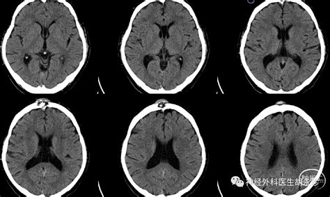 颅骨肿瘤，是什么性质？ 脑医汇