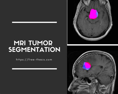 Amisha Patel On Linkedin Brain Tumor Segmentation In Mri Images Free Thesis