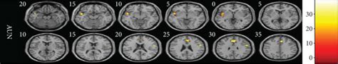 Aberrant Functional Connectivity In The Aun Dmn Dan Lfpn And Vin