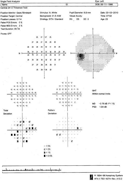 Manual Visual Field Test