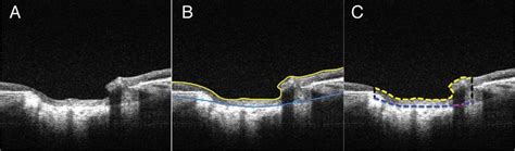 A Swept Source Oct Scan Of The Onh Of A Glaucomatous Eye B Download Scientific Diagram