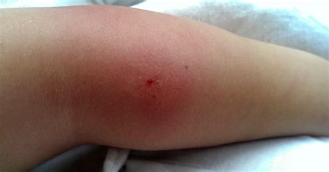 How To Tell The Difference Between A Bug Bite And A Staph Infection