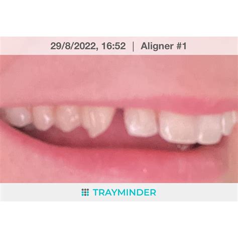 Moderate Treatment Plan For Severe Spacing Rinvisalign