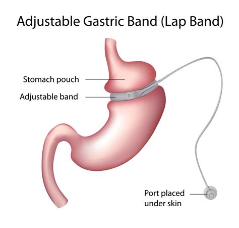 Lap Band® Los Angeles Long Beach Orange County