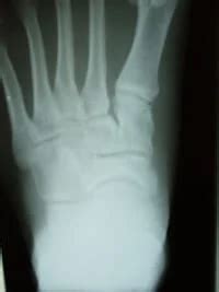Fracture Pictures Weston Fl Foot Doctor Fracture Pictures Weston Fl Foot Doctor