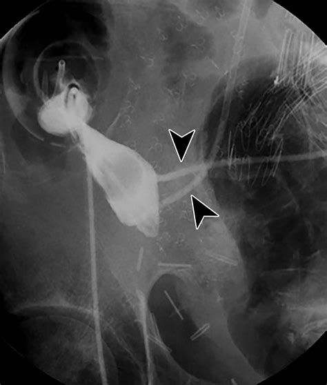 What Is A Cystoprostatectomy With Ileal Conduit At Ethan Fuhrman Blog