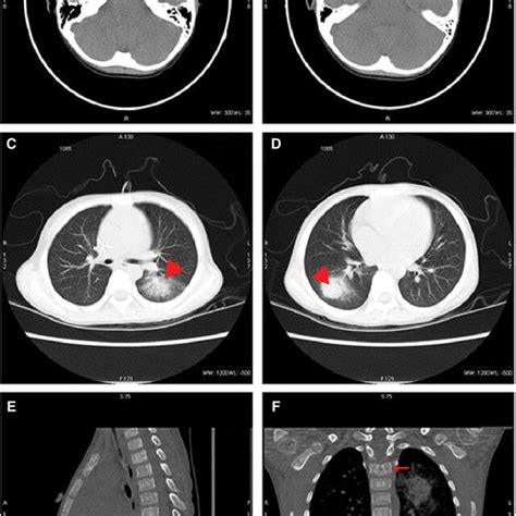 Representative Radiographs A B Ct Images Demonstrating Scalp Abscess