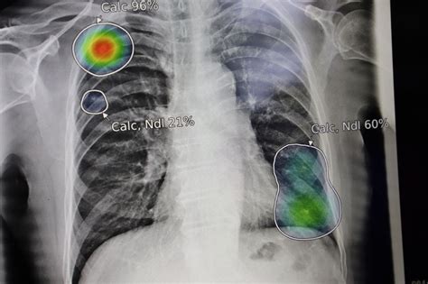 Сэлэнгэ Сүрьеэгийн эрт илрүүлэгт хиймэл оюун ухаанд суурилсан рентген оношилгоог нэвтрүүллээ