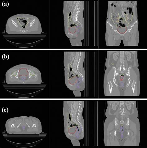 Automatic Contours For Organs At Risk Predicted By Segnet Parts A C Download Scientific
