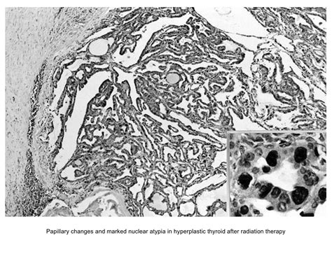 Pathology Outlines Radiation Thyroiditis