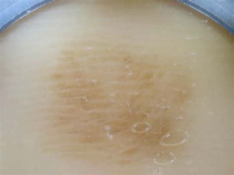 Dermoscopy Of The First Lesion Shows A Parallel Ridge Pattern And Focal Download Scientific