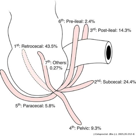 Acute Appendicitis Flashcards Quizlet