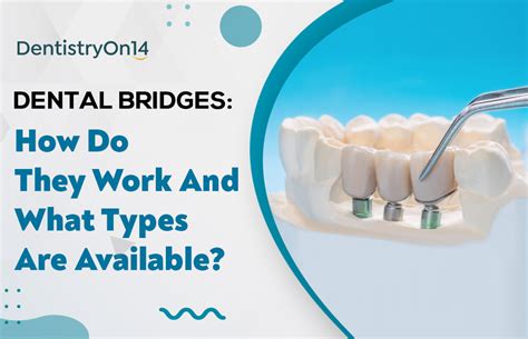 Dental Bridges How Do They Work And What Types Are Available