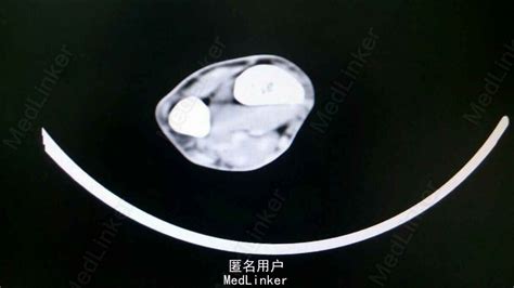 病理性骨折
