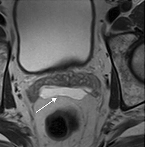 Fiducial Markers Versus Calcifications On Mri Axial T2 Weighted A Download Scientific