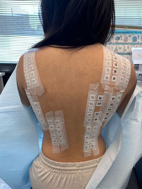 Heres What Getting A Skin Patch Test Is Really Like SELF