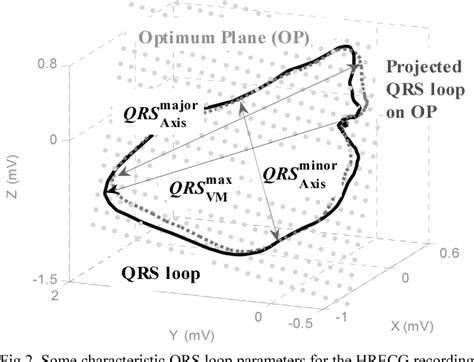 Table Ii From Analysis Of Qrs Loop In The Vectorcardiogram Of Patients