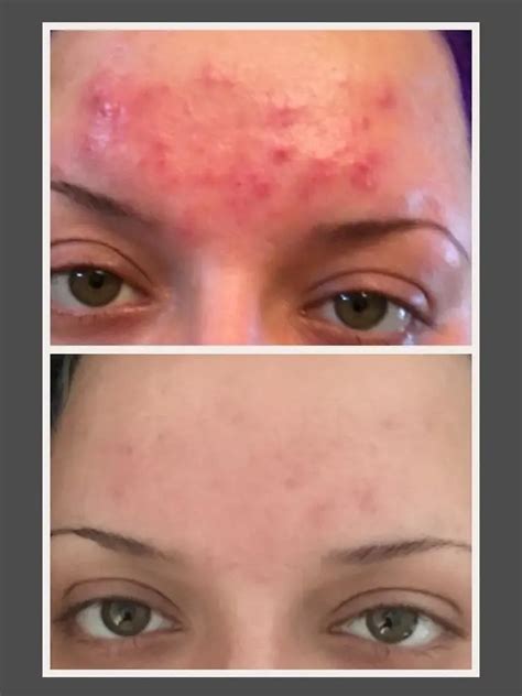 Acne Redness Artofit