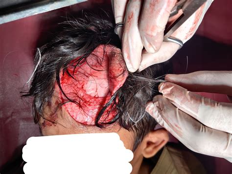 Scalp Laceration Medizzy