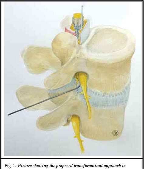 Percutaneous Implantation Of Neurostimulator Electrodes Sacral Nerve Transforaminal Placement