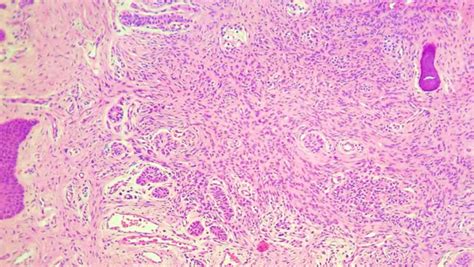 Fibroblastic Proliferation With Islets Of Odontogenic Epithelium And