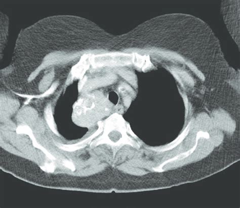 Heterogeneous Hypertrophic Nodular Thyroid Gland With Multiple Download Scientific Diagram