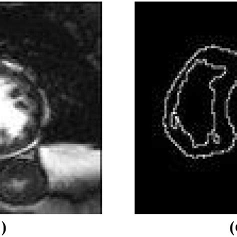 myocardial border detection a en border detection result b ep download scientific diagram