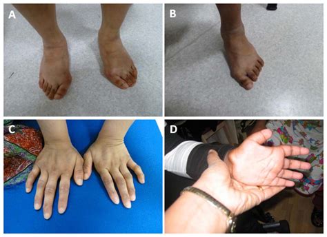 Novel Pex11b Mutations Extend The Peroxisome Biogenesis Disorder 14b Phenotypic Spectrum And