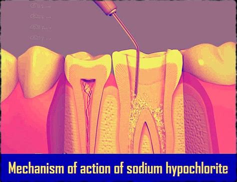 Sodium Hypochlorite Endodontics Concentration At Liam Wimble Blog