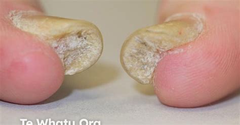 Psoriatic Nail Dystrophy Image