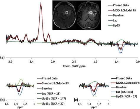 Lactate As Clinical Tumour Biomarker Optimization Of Lactate Detection And Quantification In Mr