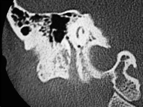 Peripheral Primitive Neuroectodermal Tumor A Rare Case Of Peripheral Facial Paralysis
