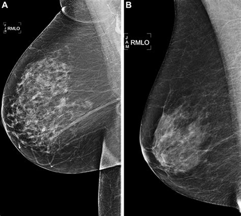 Ai Surpasses Standard Risk Model In Breast Cancer Prediction Rsna